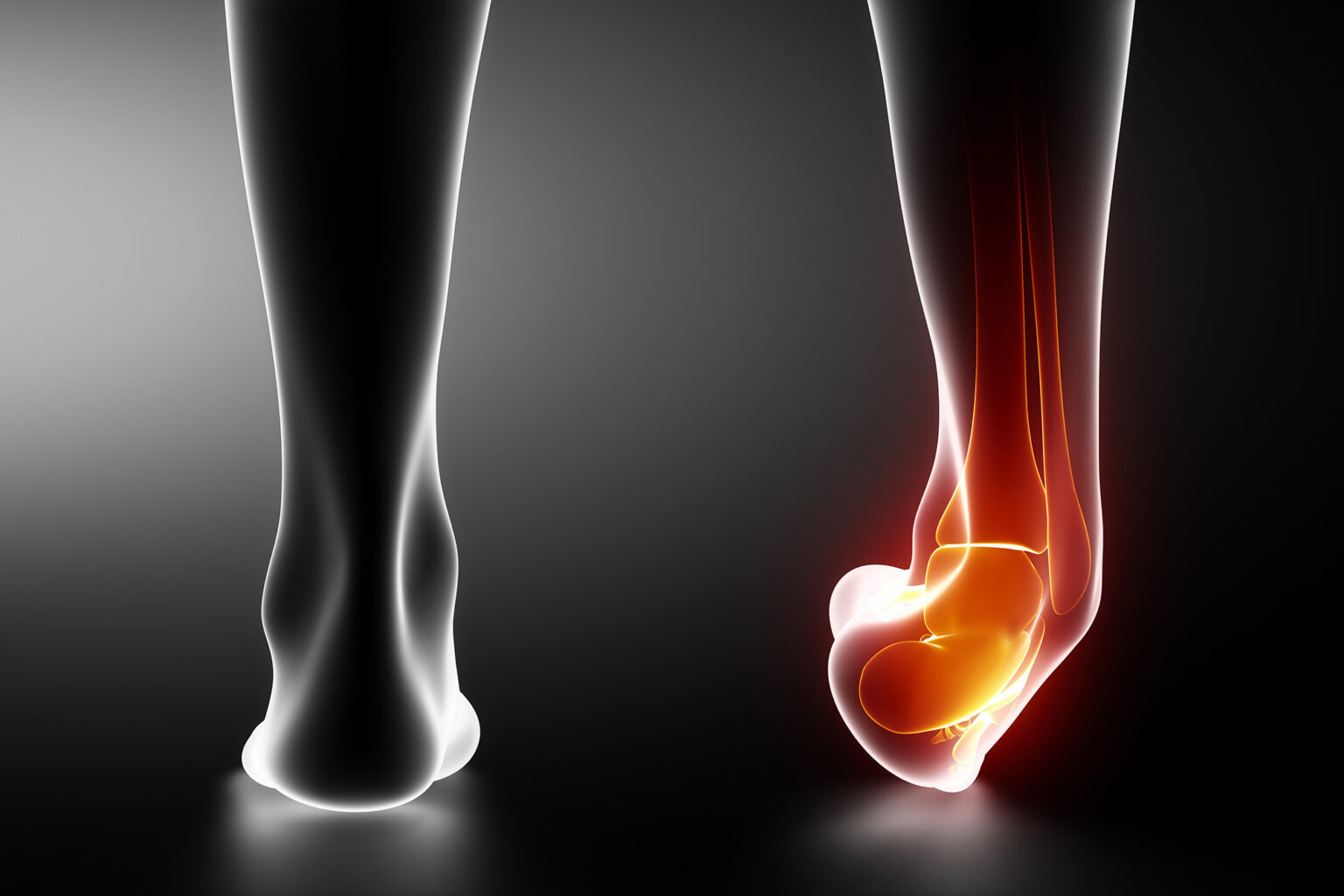 Lateral Ankle Sprain: A Brief Summary & The Role of Physiotherapy
